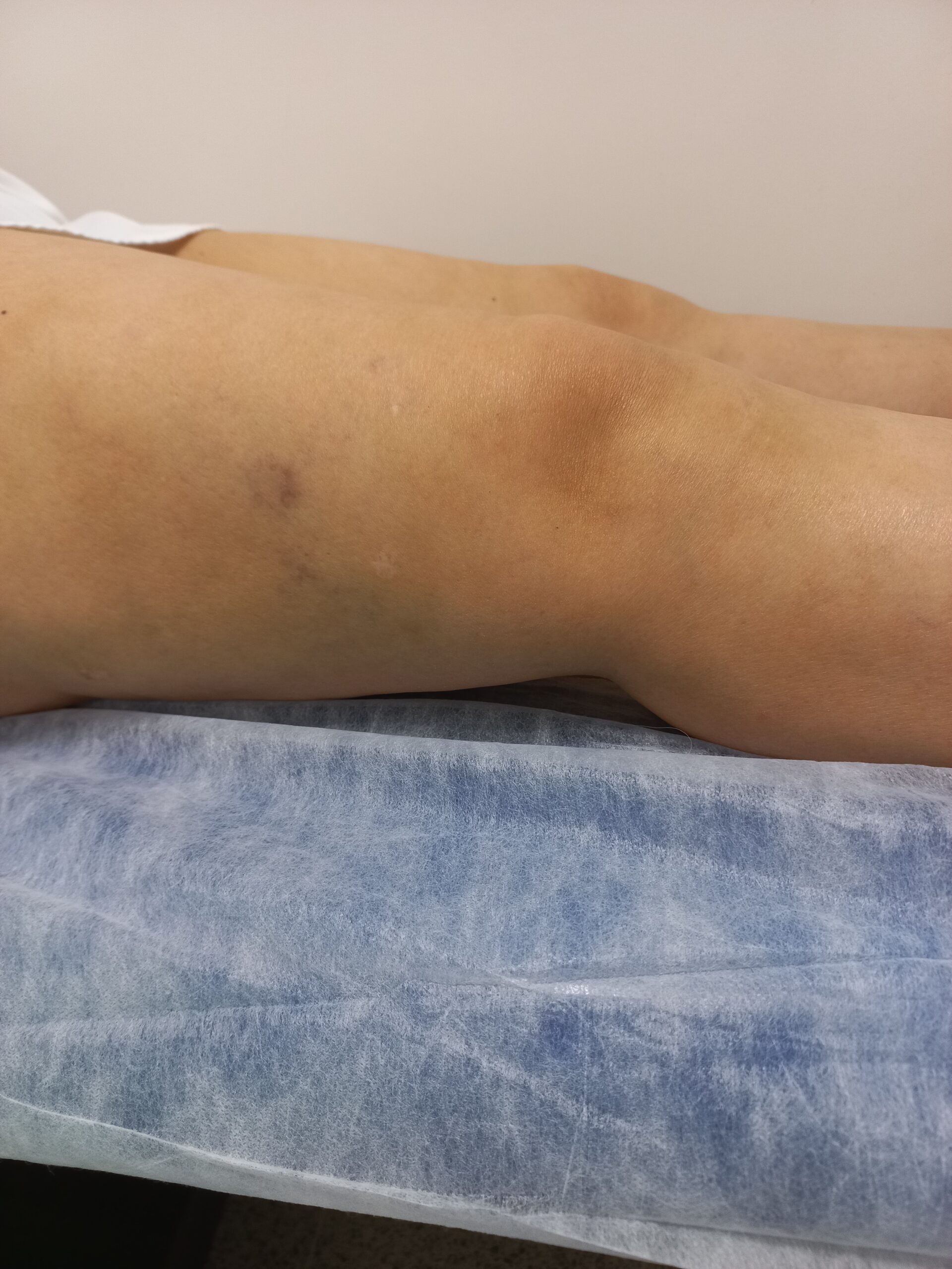 Moretones sin Golpe | Causas y Cuándo Consultar al Médico | Dr. Jose ...